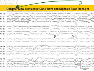 Positive Occipital Sharp Transients of Sleep, Posterior slow-wave ...