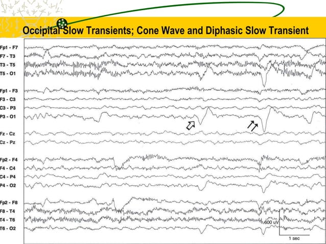 Positive Occipital Sharp Transients of Sleep, Posterior slow-wave ...