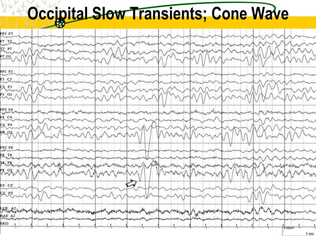 Positive Occipital Sharp Transients of Sleep, Posterior slow-wave transients associated with eye ...