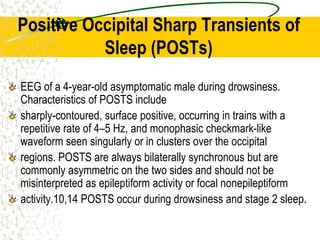 Positive Occipital Sharp Transients of Sleep, Posterior slow-wave ...
