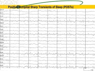 Positive Occipital Sharp Transients of Sleep, Posterior slow-wave ...