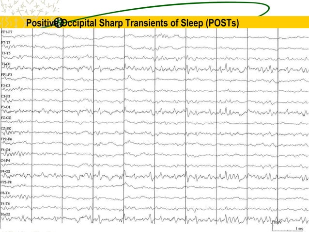 Positive Occipital Sharp Transients of Sleep, Posterior slow-wave ...