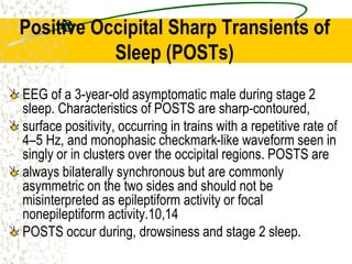 Positive Occipital Sharp Transients of Sleep, Posterior slow-wave ...