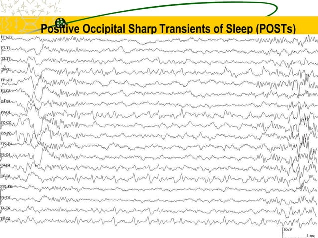 Positive Occipital Sharp Transients of Sleep, Posterior slow-wave ...