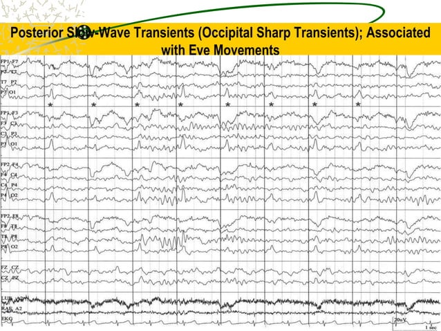 Positive Occipital Sharp Transients of Sleep, Posterior slow-wave ...