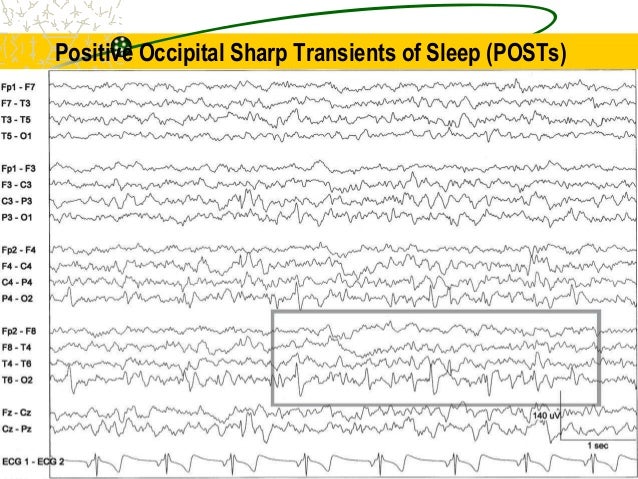 Positive Occipital Sharp Transients of Sleep, Posterior slow-wave tra…