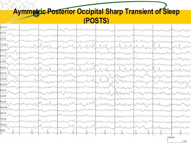 Positive Occipital Sharp Transients of Sleep, Posterior slow-wave tra…