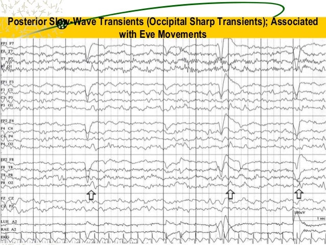 Positive Occipital Sharp Transients of Sleep, Posterior slow-wave tra…
