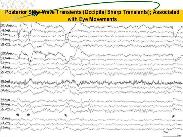 Positive Occipital Sharp Transients of Sleep, Posterior slow-wave tra…