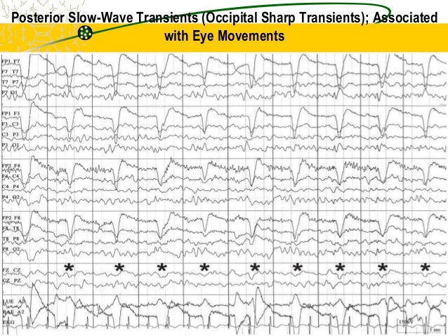 Positive Occipital Sharp Transients of Sleep, Posterior slow-wave tra…