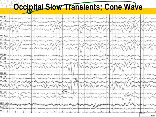 Positive Occipital Sharp Transients of Sleep, Posterior slow-wave tra…