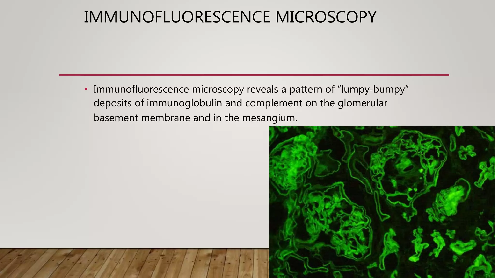 Post streptococcal glomerulonephritis | PPTX