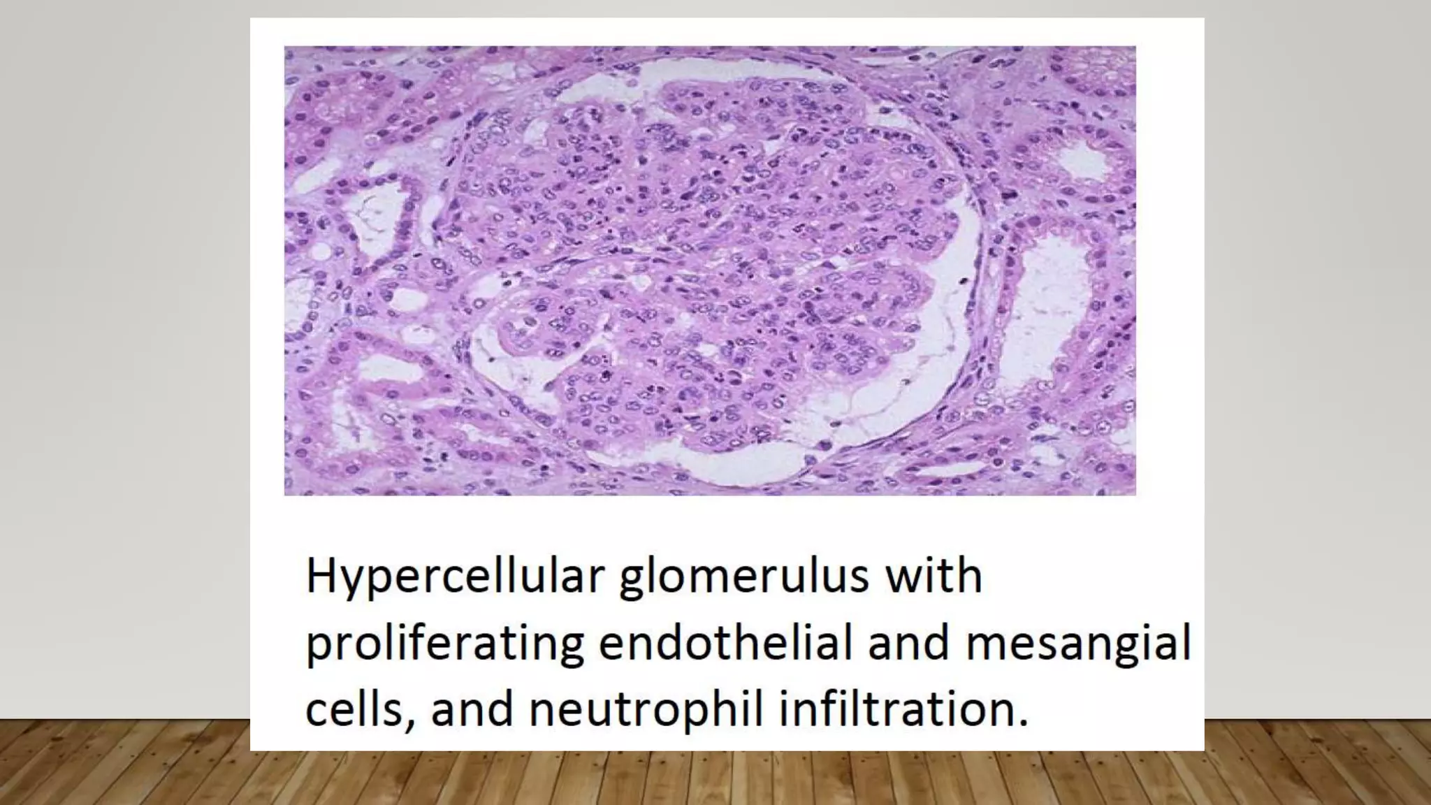 Post streptococcal glomerulonephritis | PPTX