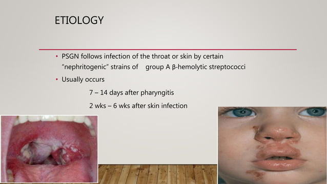 Post streptococcal glomerulonephritis | PPT