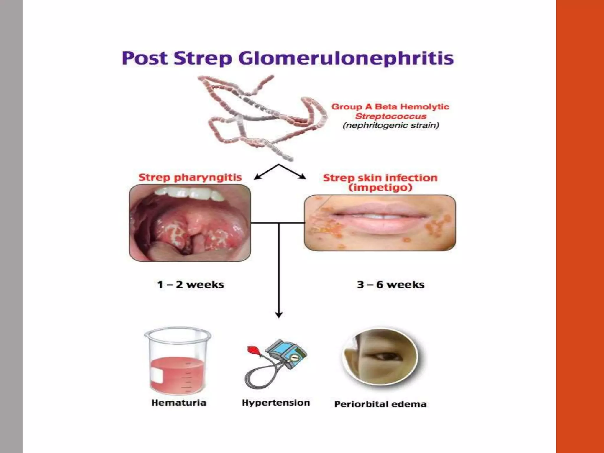 Post streptococcal glomerulo nephritis | PPTX