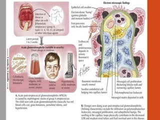 Post streptococcal glomerulo nephritis | PPTX