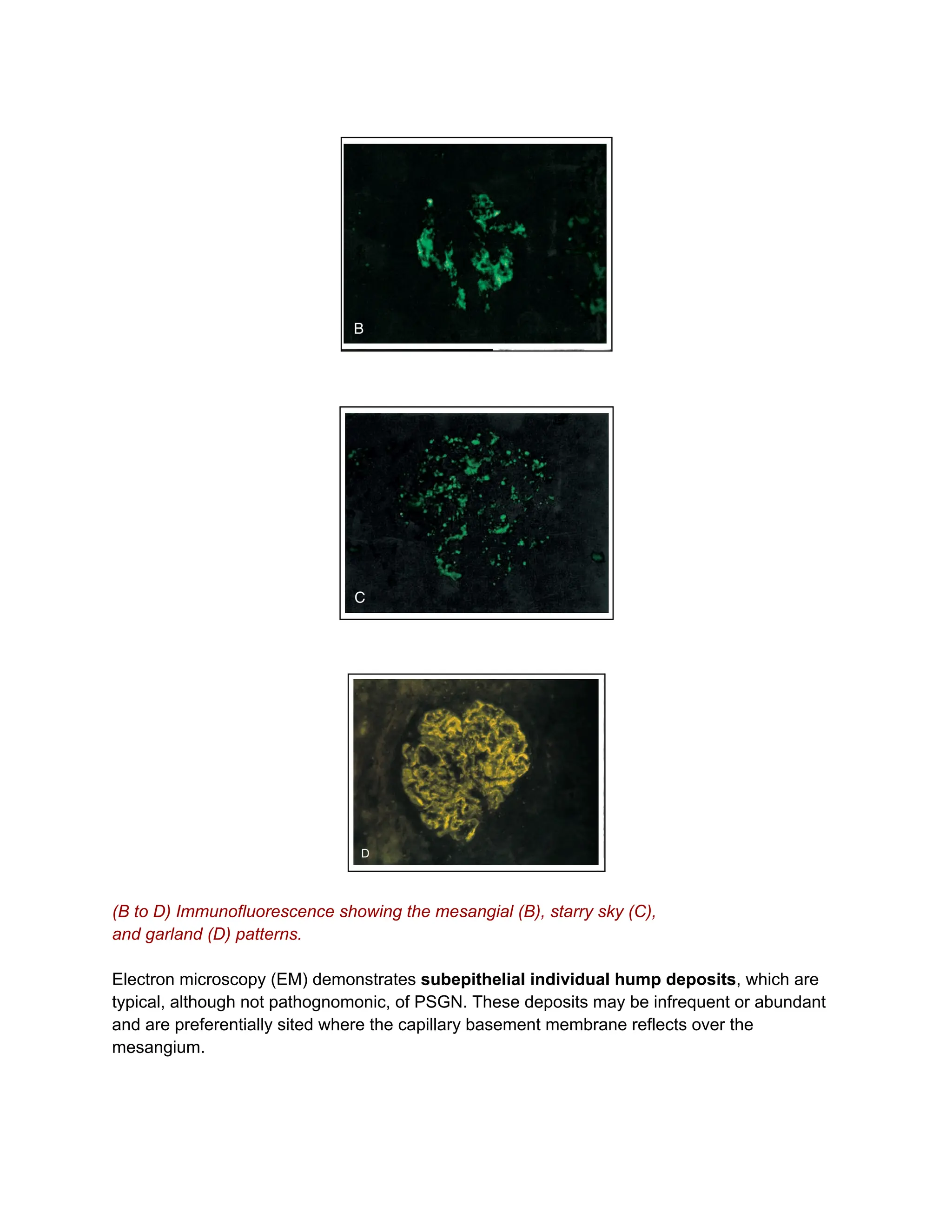 POST STREPTOCOCCAL GLOMERULONEPHRITIS.pdf