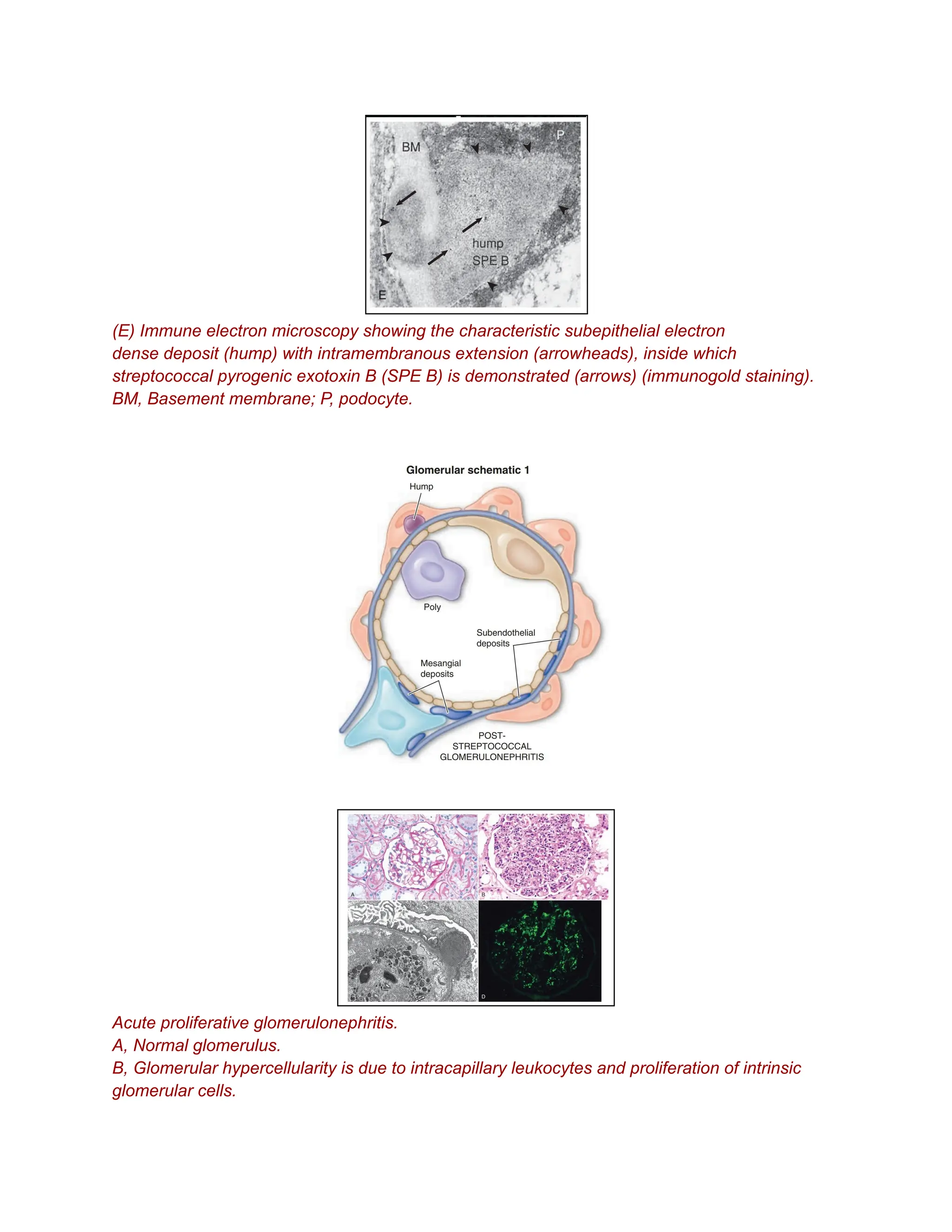 POST STREPTOCOCCAL GLOMERULONEPHRITIS.pdf