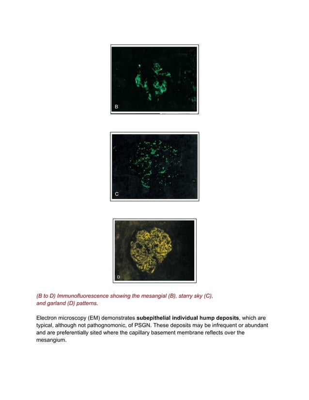 POST STREPTOCOCCAL GLOMERULONEPHRITIS.pdf