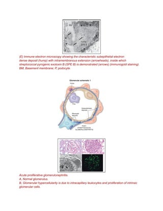 POST STREPTOCOCCAL GLOMERULONEPHRITIS.pdf