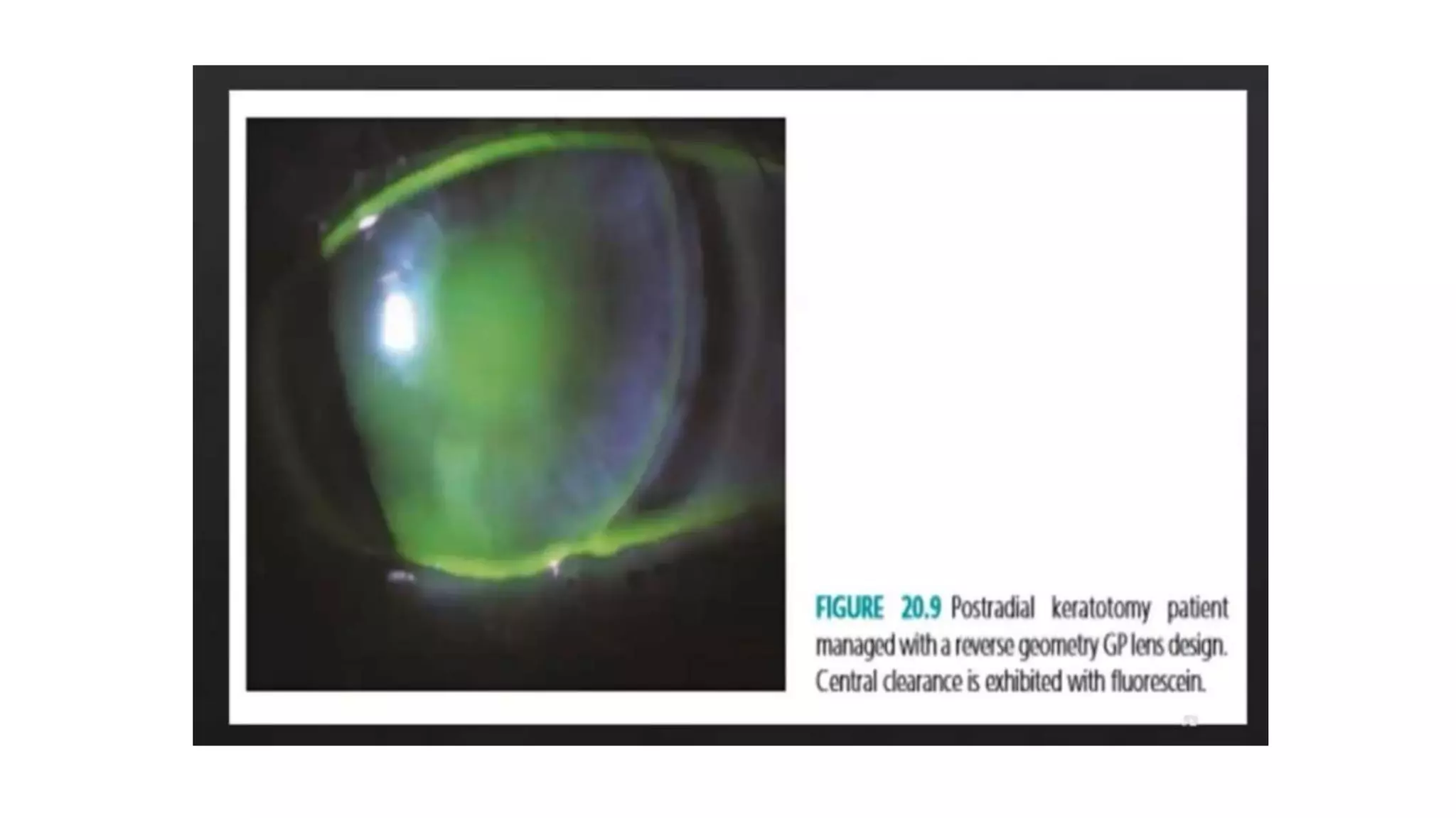Post surgical contact lens.pptx