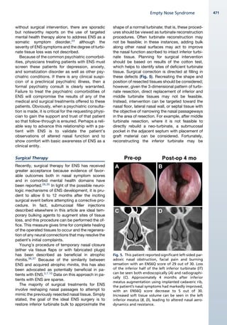 Postsurgical Management of Empty Nose Syndrome (ENS) Talmadge Nayak et ...