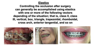 Postsurgical orthodontics | PPTX
