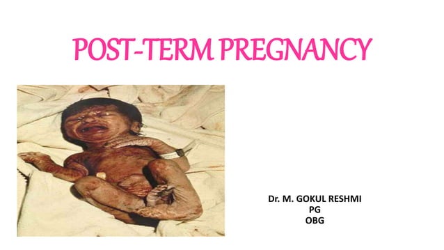 Postterm pregnancy | PPTX | Pregnancy | Reproductive Health