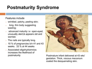 Post term pregnancy | PPT