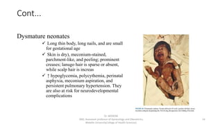 Post term pregnancy by Dr. Akebom, 2024.pptx