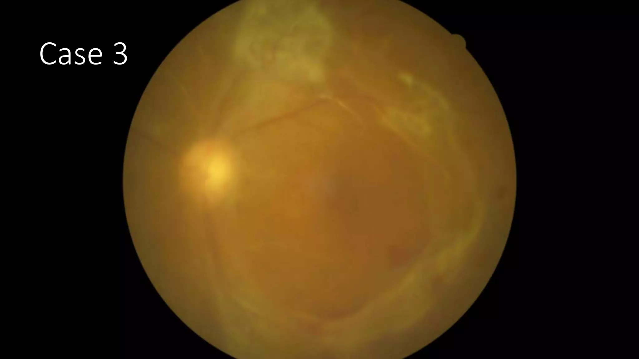 Post Test Detection Of Diabetic Retinopathy Using Fundus Photos Online Quiz Ppt