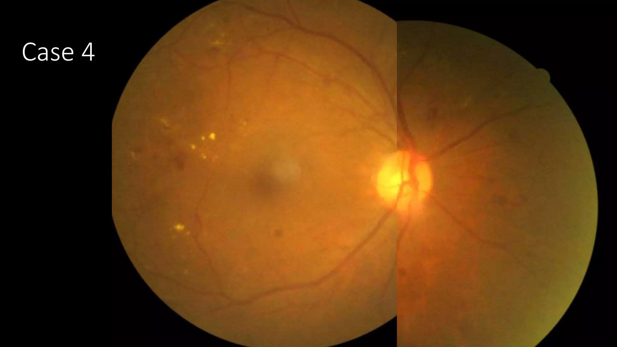 Post Test Detection Of Diabetic Retinopathy Using Fundus Photos Online Quiz Ppt