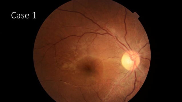 POST-TEST Detection of diabetic retinopathy using fundus photos online ...