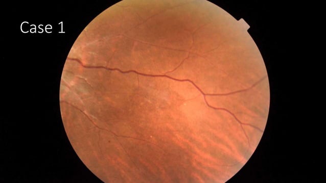 POST-TEST Detection of diabetic retinopathy using fundus photos online ...