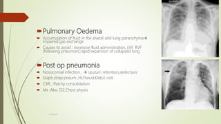 Post thoracic surgery complications | PPTX