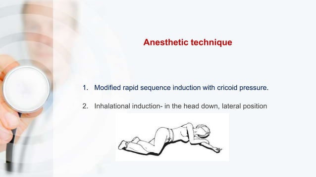 Post tonsillectomy bleed & anesthesia considerations | PPTX