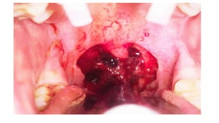 POST TONSILLECTOMY BLEEDING.pptx