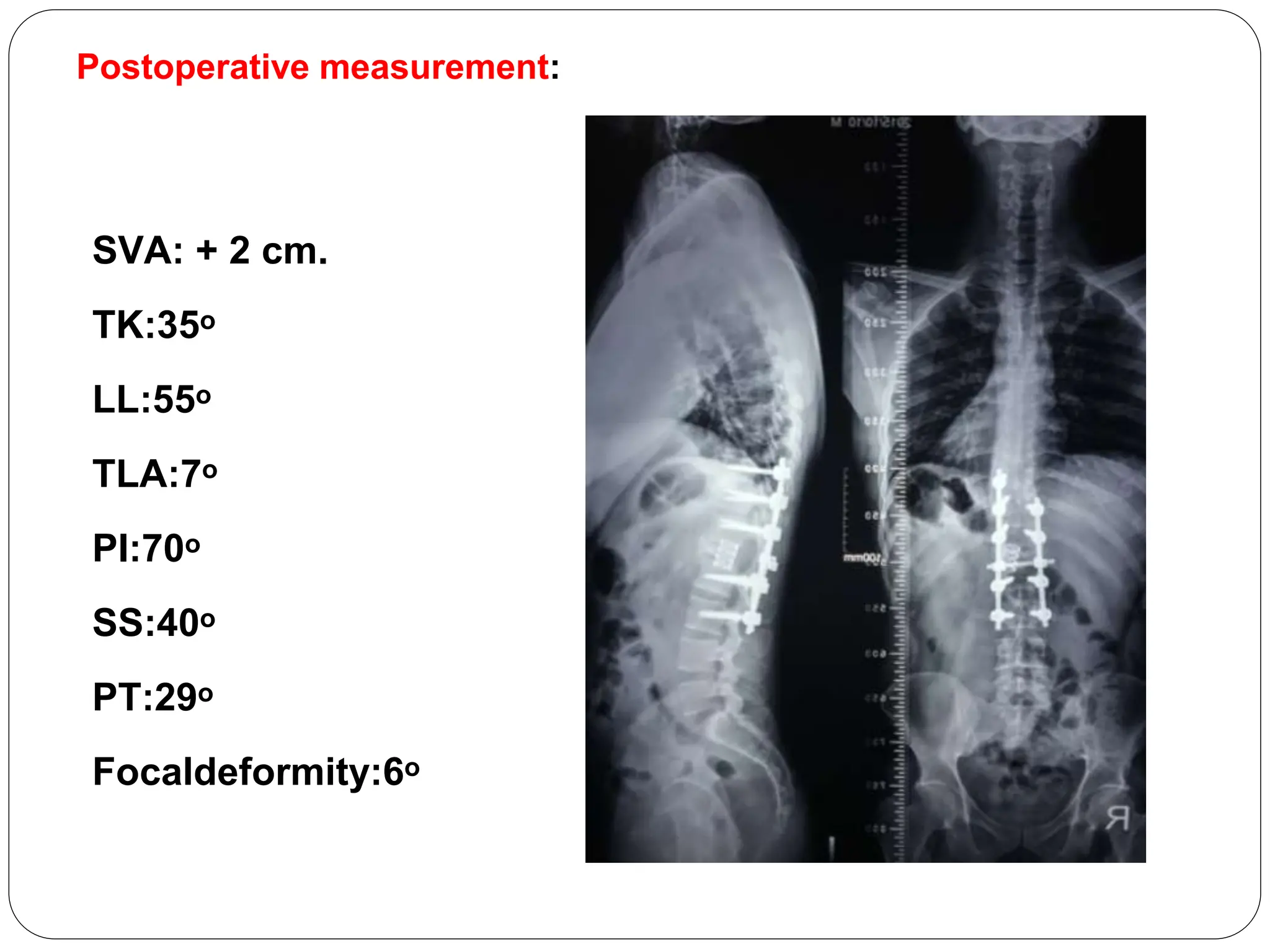 posttraumatic kyphosis ppt -D12 الجمعية.pptx | Physical Therapy | Wellness