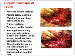 posttraumatic kyphosis ppt -D12 الجمعية.pptx | Physical Therapy | Wellness