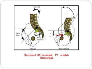 posttraumatic kyphosis ppt -D12 الجمعية.pptx | Physical Therapy | Wellness
