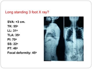 posttraumatic kyphosis ppt -D12 الجمعية.pptx