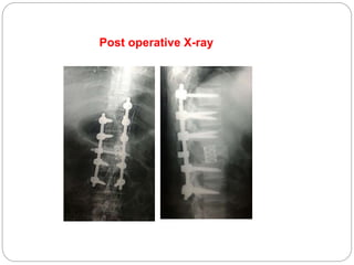 posttraumatic kyphosis ppt -D12 الجمعية.pptx