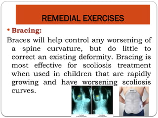 Postural-Deformities.pptxbsbsjssbsbsbsnsnhs | PPTX