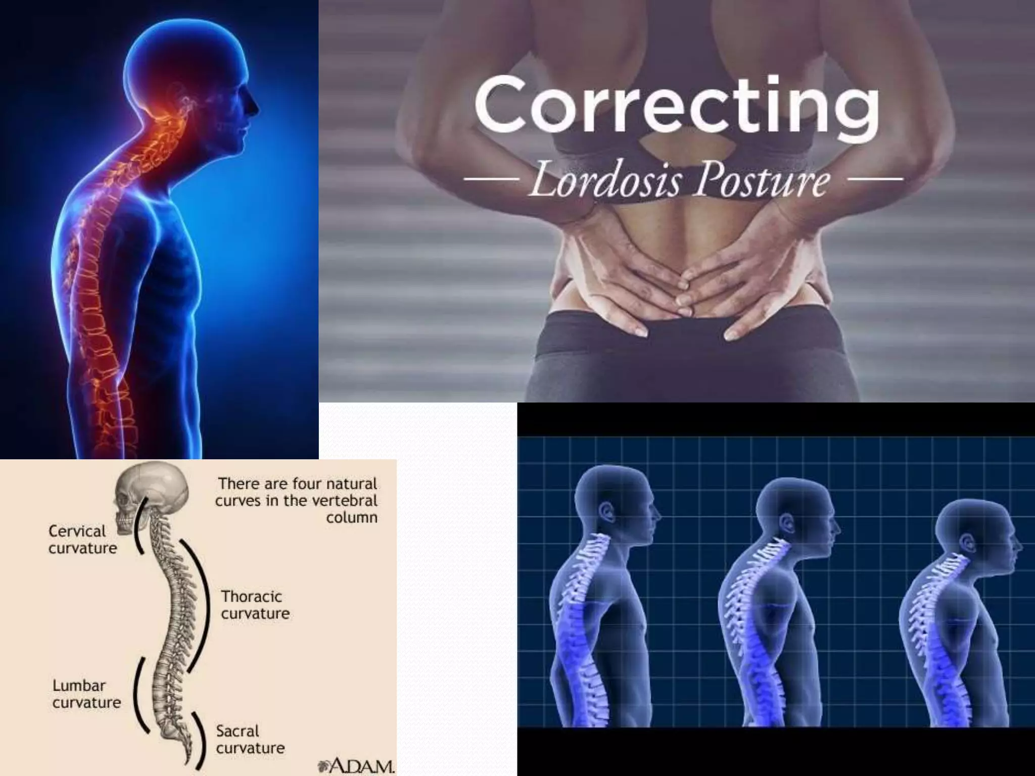 Postural deviations of spine by Dr. Nidhi | PPTX
