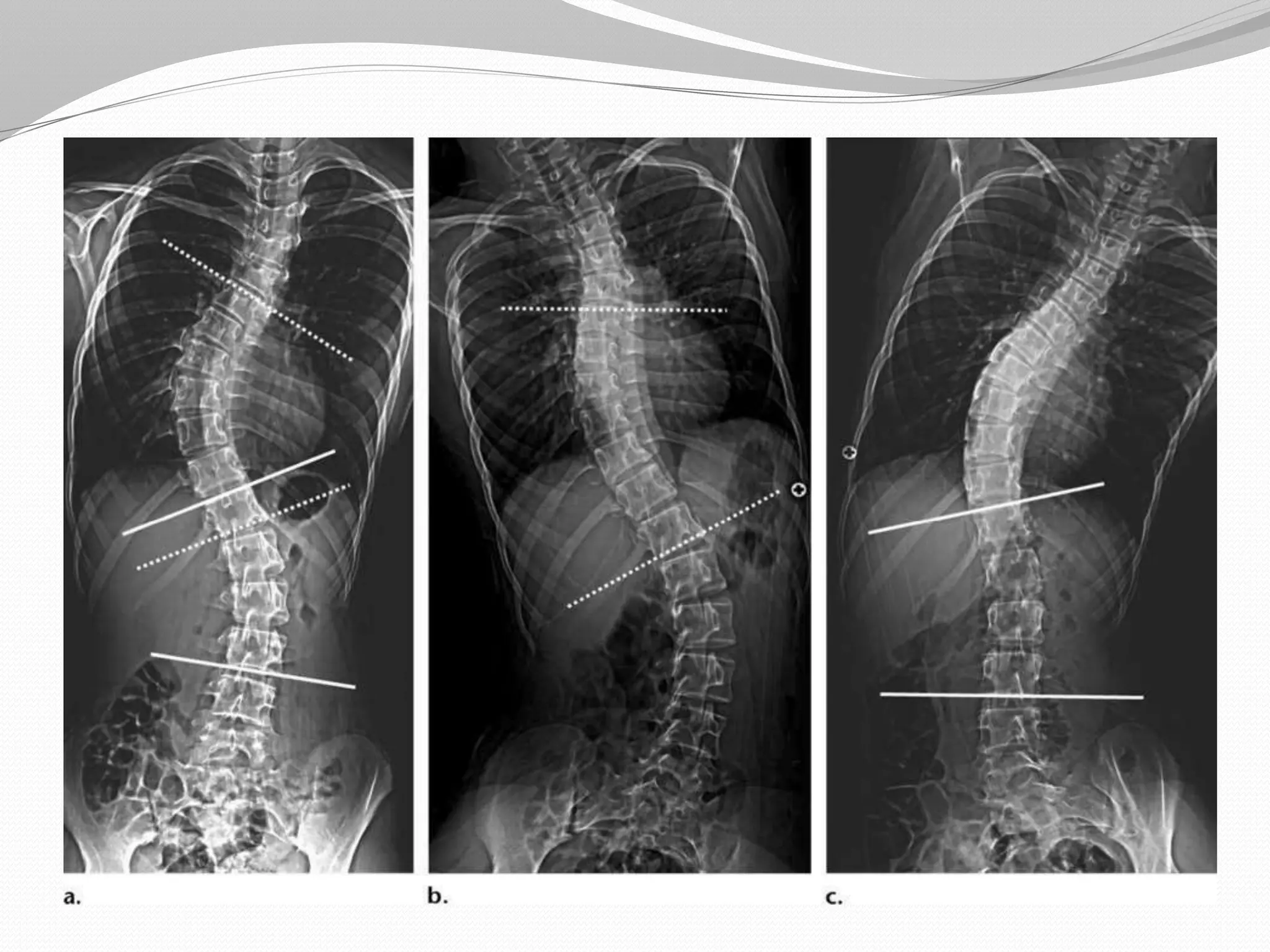 Postural deviations of spine by Dr. Nidhi | PPTX