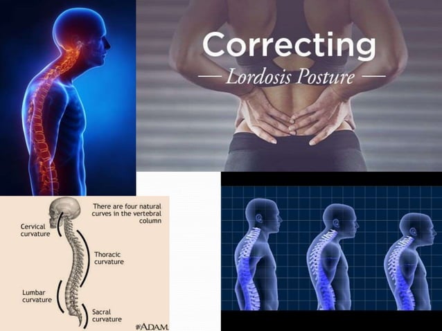 Postural deviations of spine by Dr. Nidhi | PPTX