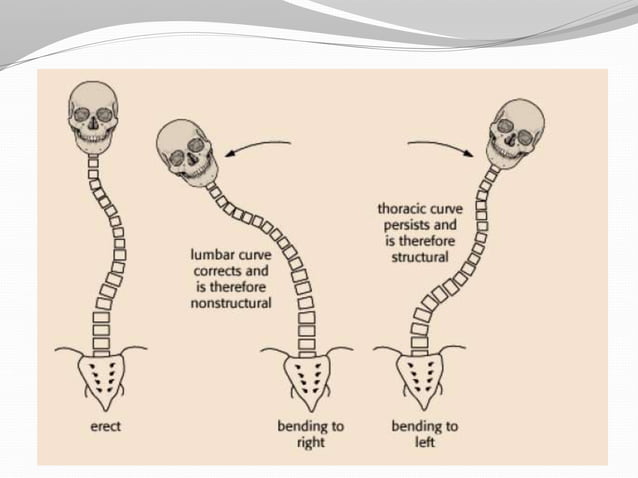 Postural deviations of spine by Dr. Nidhi | PPTX