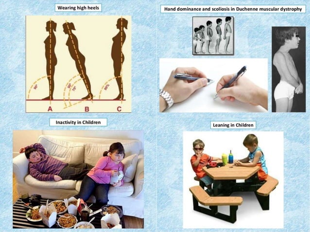 Postural deviations of spine by Dr. Nidhi | PPTX