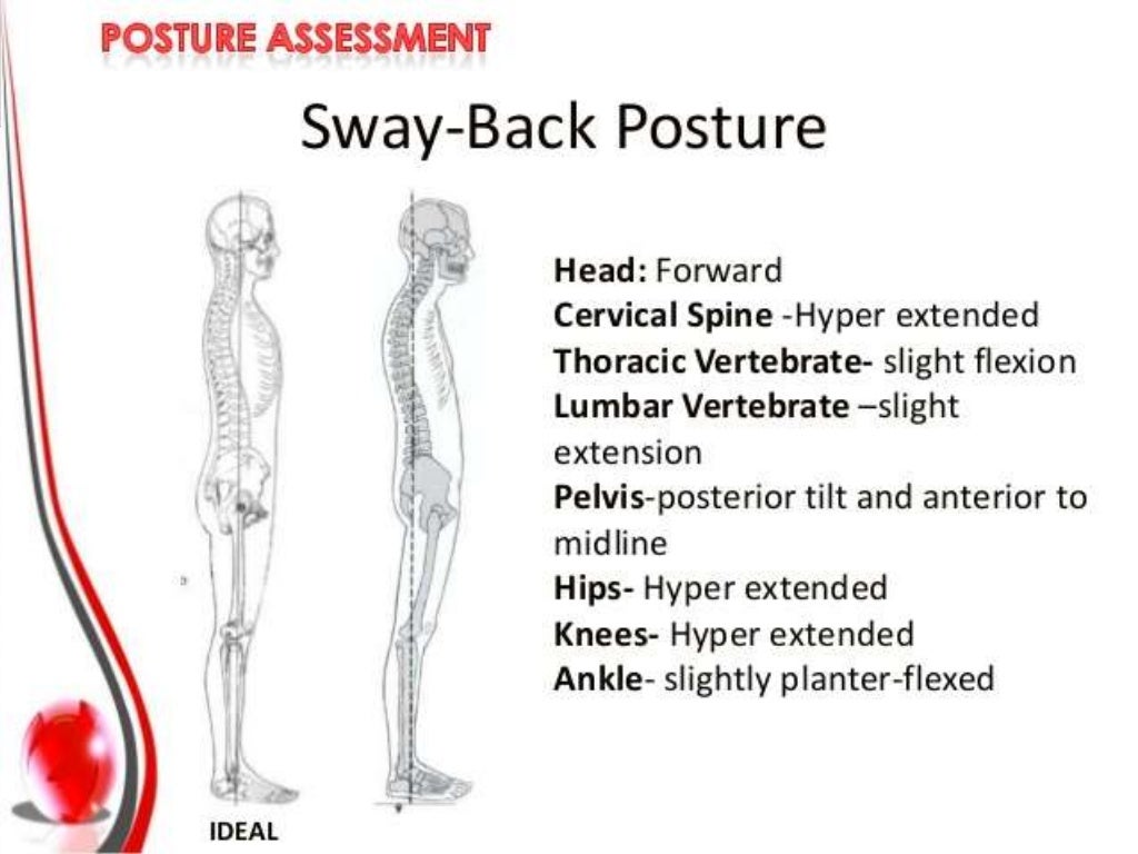 Postural deviations of spine by Dr. Nidhi