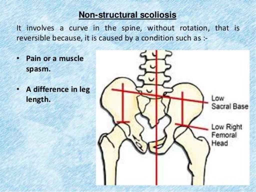 Postural deviations of spine by Dr. Nidhi
